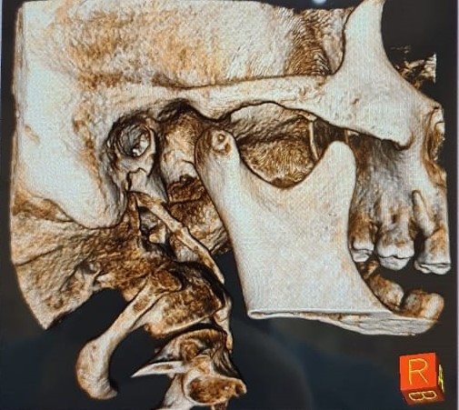 Eagle’s Syndrome: Endoscopic Trans Palatal Bilateral Styloidectomy ...