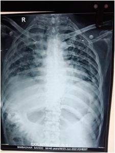 Autologous Blood Patch in Persistent Pneumothorax | KIIT University ...